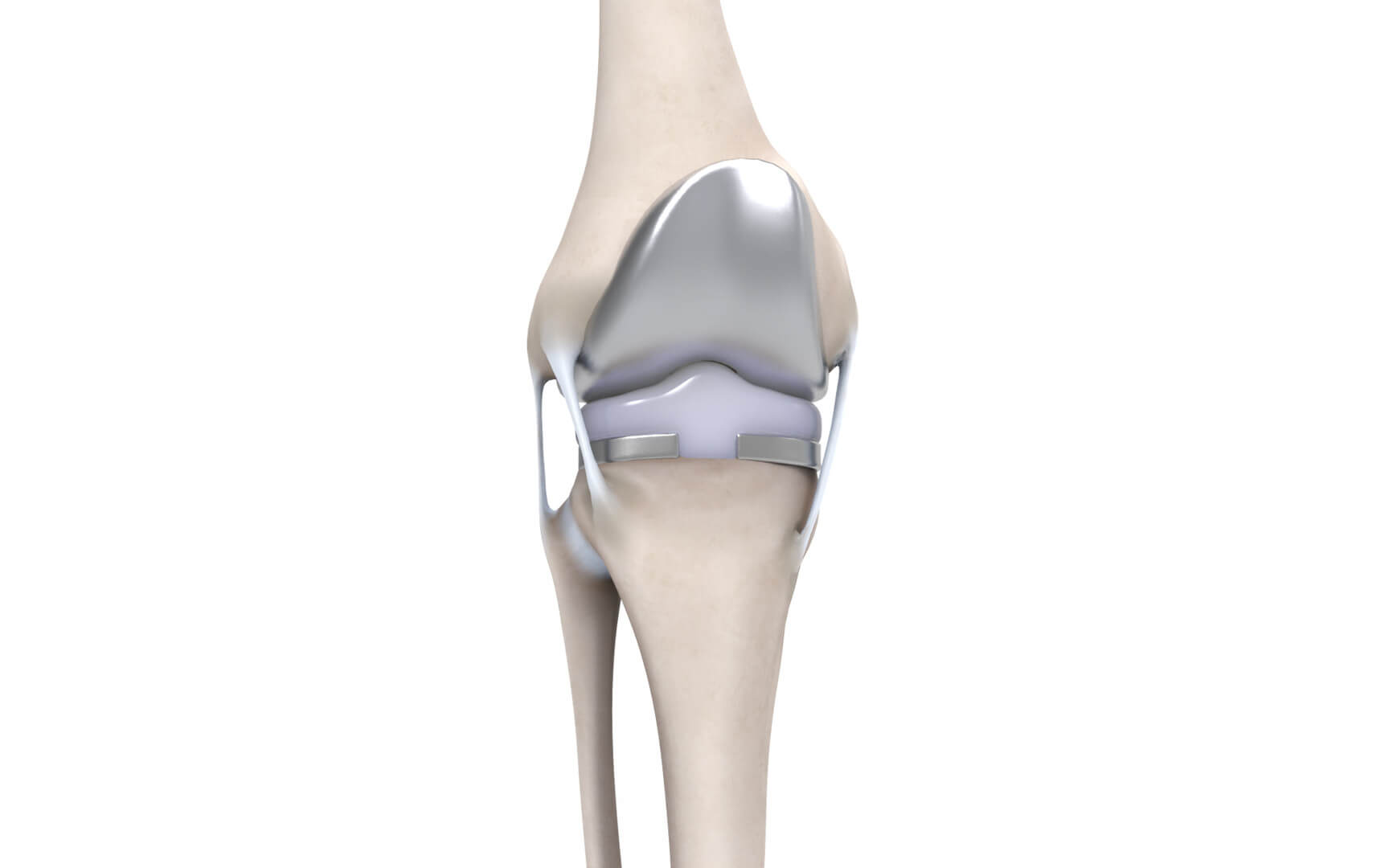 Knee Replacement - 3D Model by zames1992d