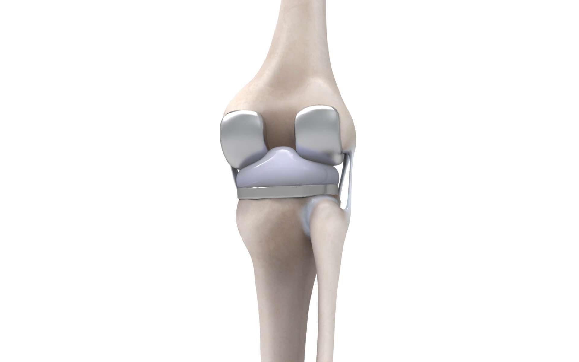 Knee Replacement - 3D Model by zames1992d