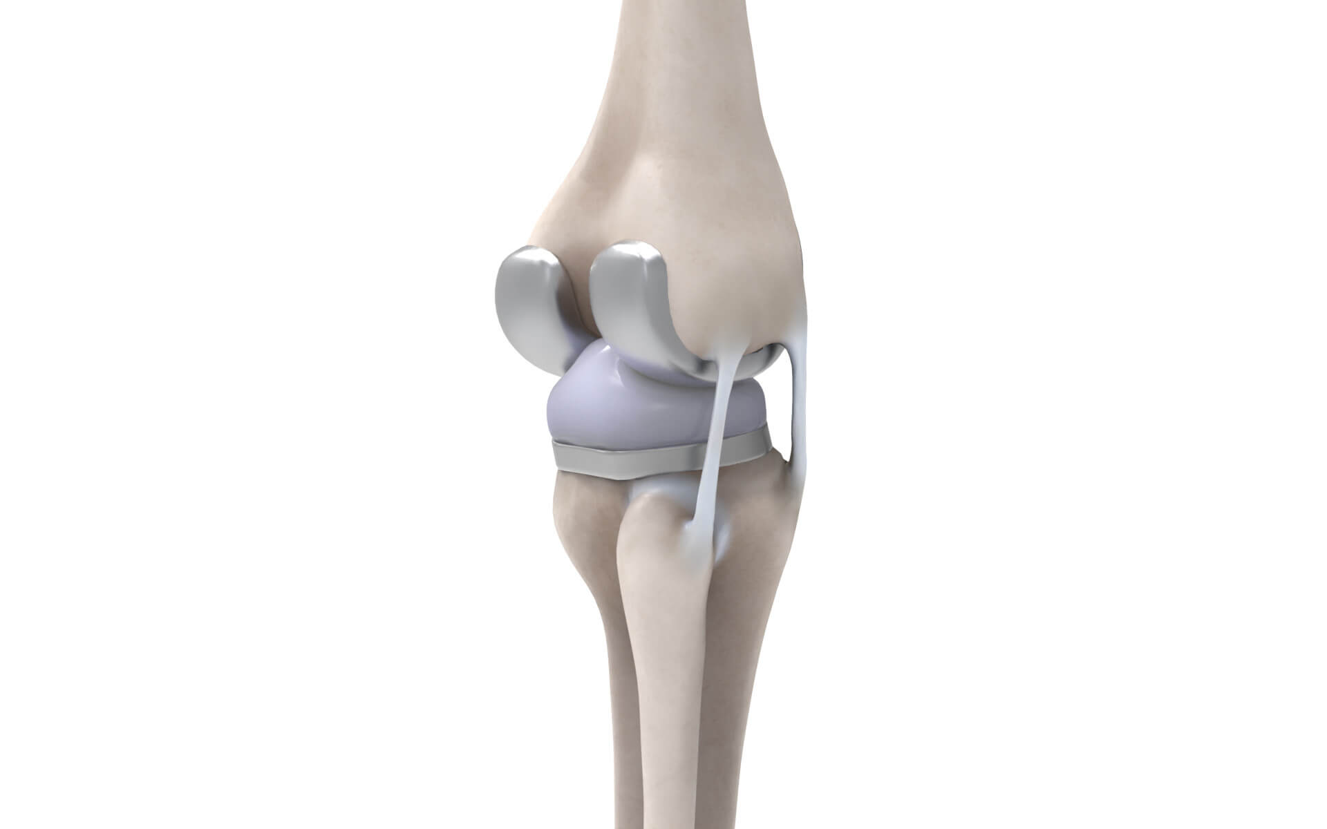 Knee Replacement - 3D Model by zames1992d