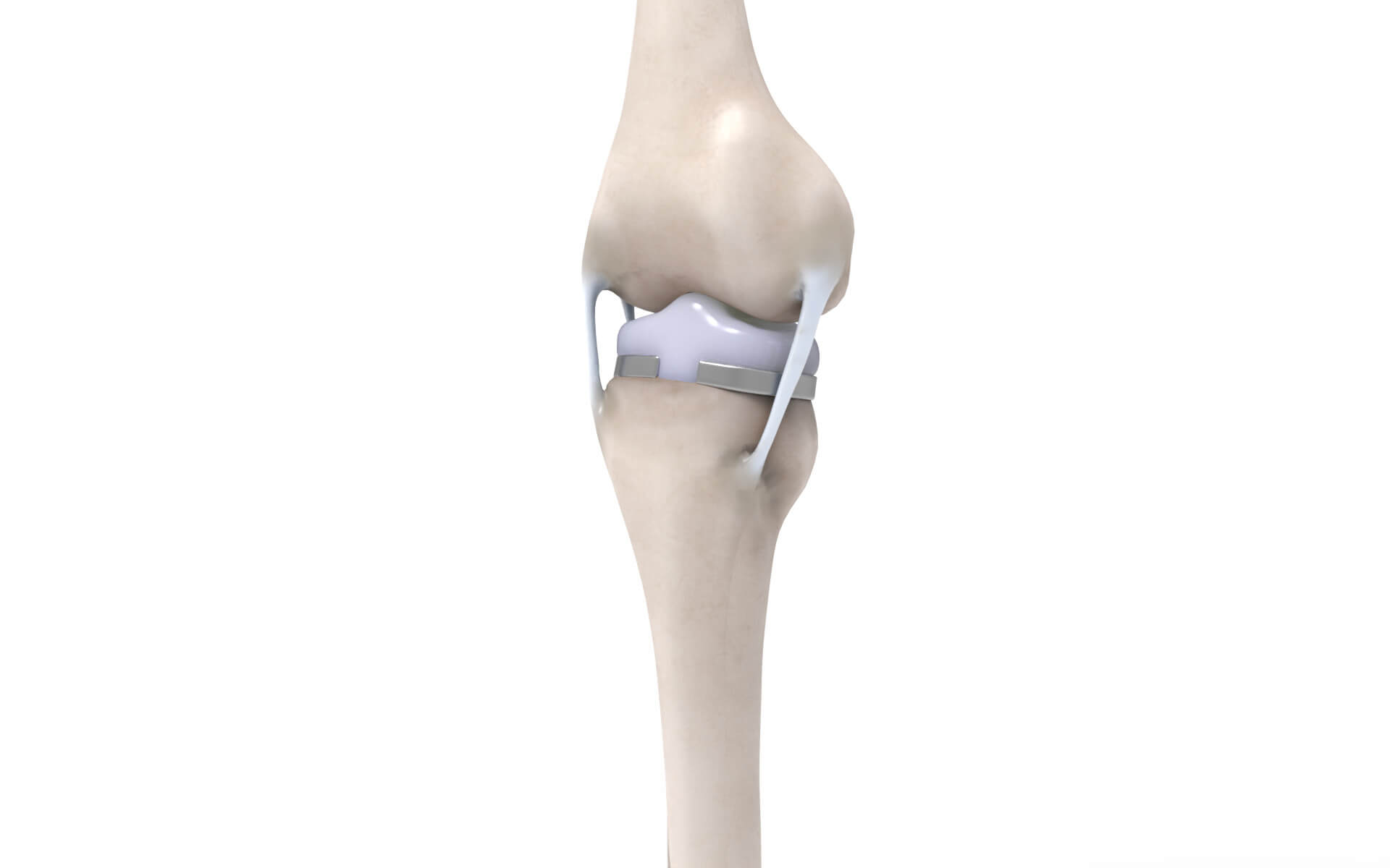 Knee Replacement - 3D Model by zames1992d