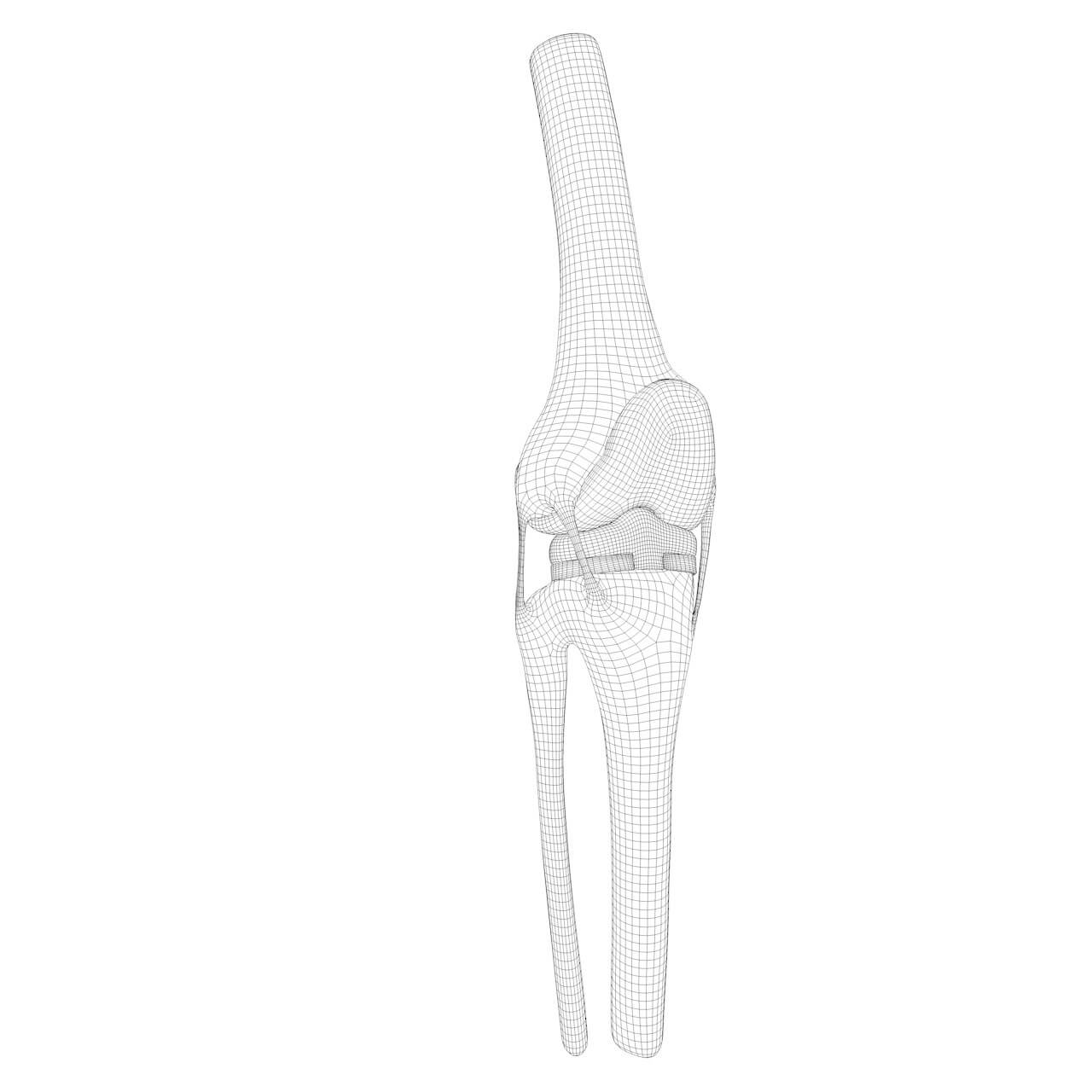 Knee Replacement - 3D Model by zames1992d